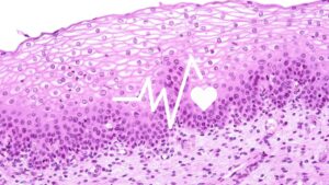 Epithelial Cell Abnormality Causes, Symptoms and Treatment