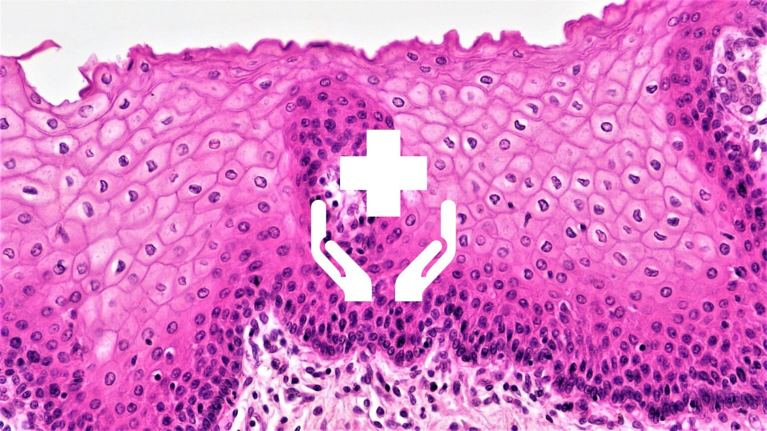 Epithelial Cell Abnormality Causes, Symptoms and Treatment