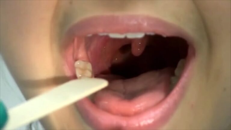 Chlamydia in the Throat - What You Should Know