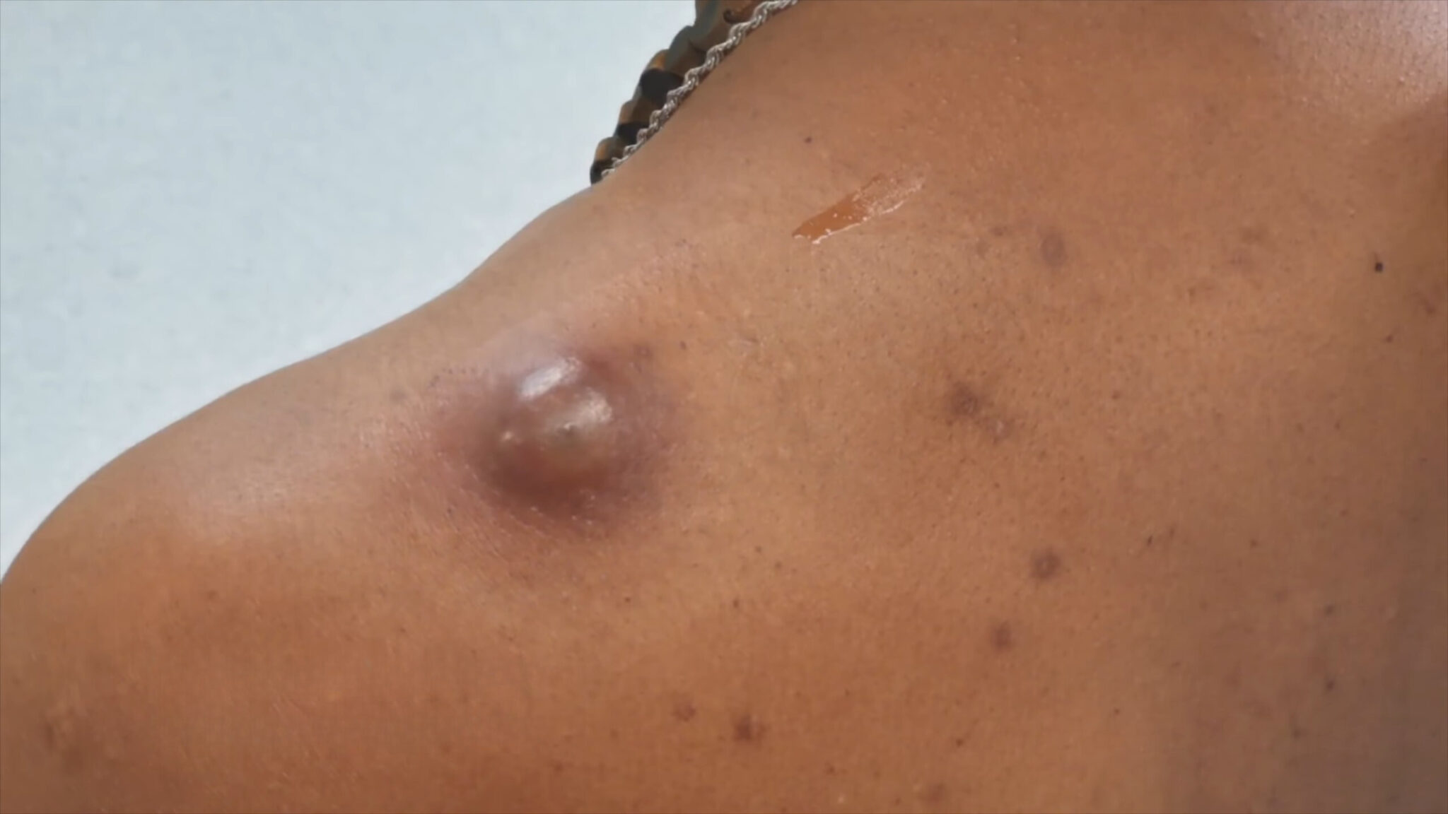 Boil vs. Cyst: Telling the Difference